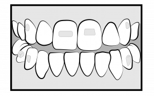 Invisalign Treatment Plan - Cooney & Tyner Orthodontics