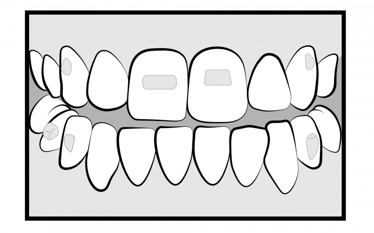 Invisalign Treatment Plan - Cooney & Tyner Orthodontics